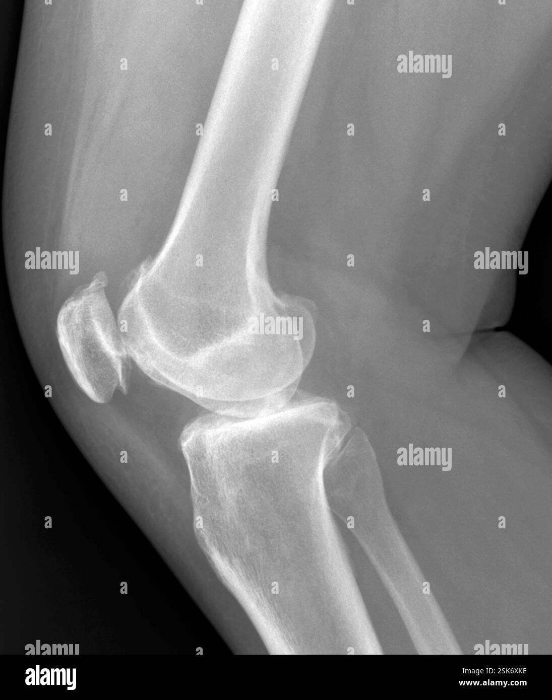 Knee in osteoarthritis. X-ray of a side view of the right knee of a 73 ...