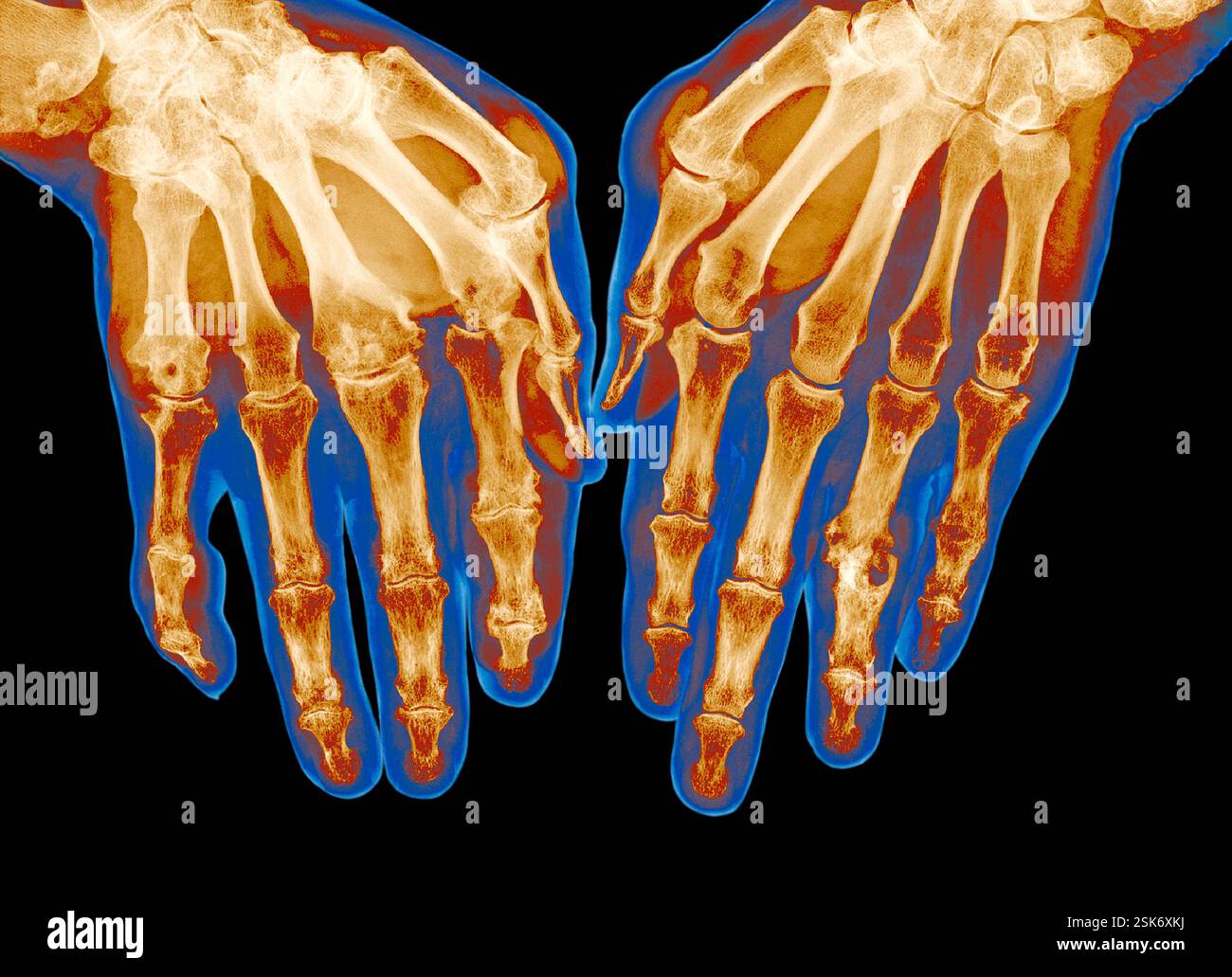 Gout. Coloured X-ray of the hands of a patient with gout in the joints ...