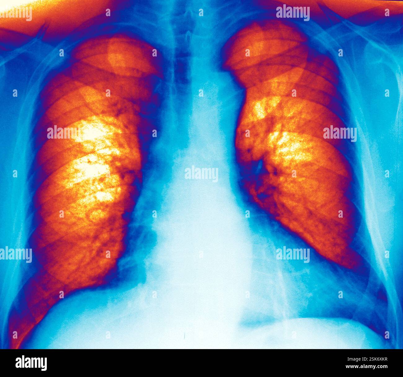 Breathing. Coloured X-ray showing inhalation. The horizontal bands are ...