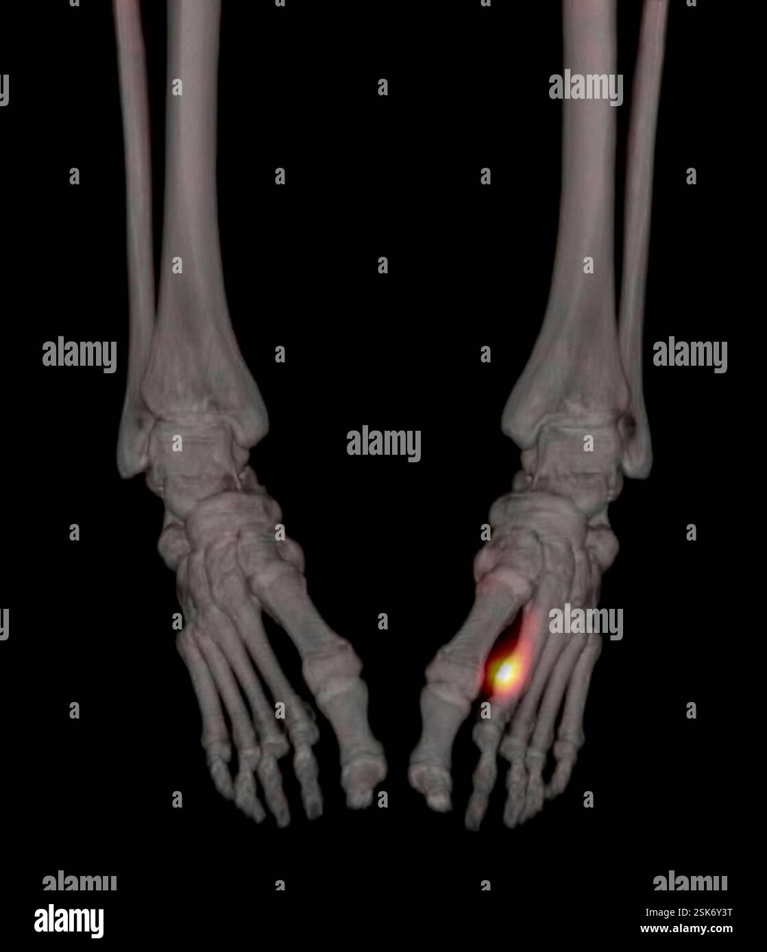Stress fracture. Coloured composite 3D computed tomography (CT) scan ...