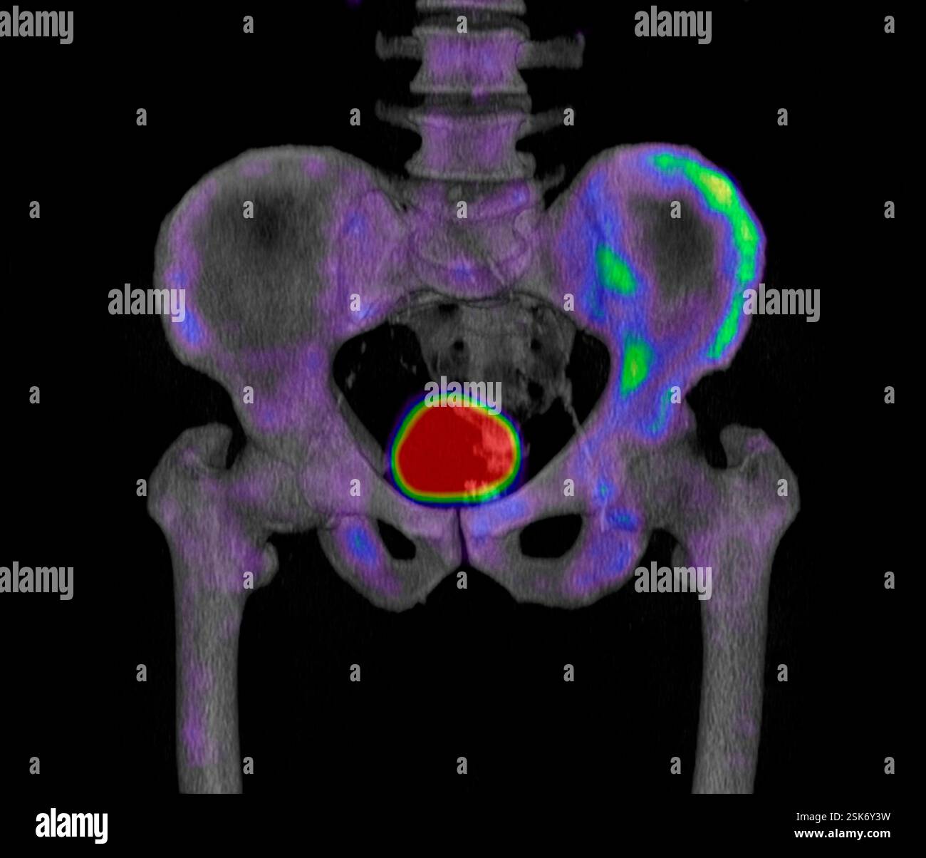 Metastatic prostate cancer. Coloured composite image combining 3D ...