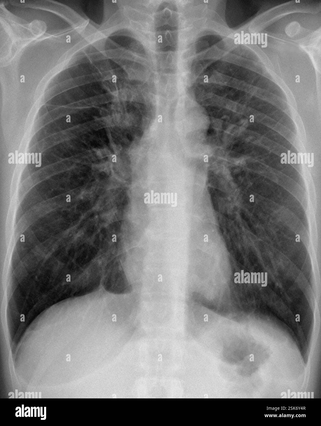 Pulmonary fibrosis in sarcoidosis. Frontal X-ray of the chest of a 42 ...
