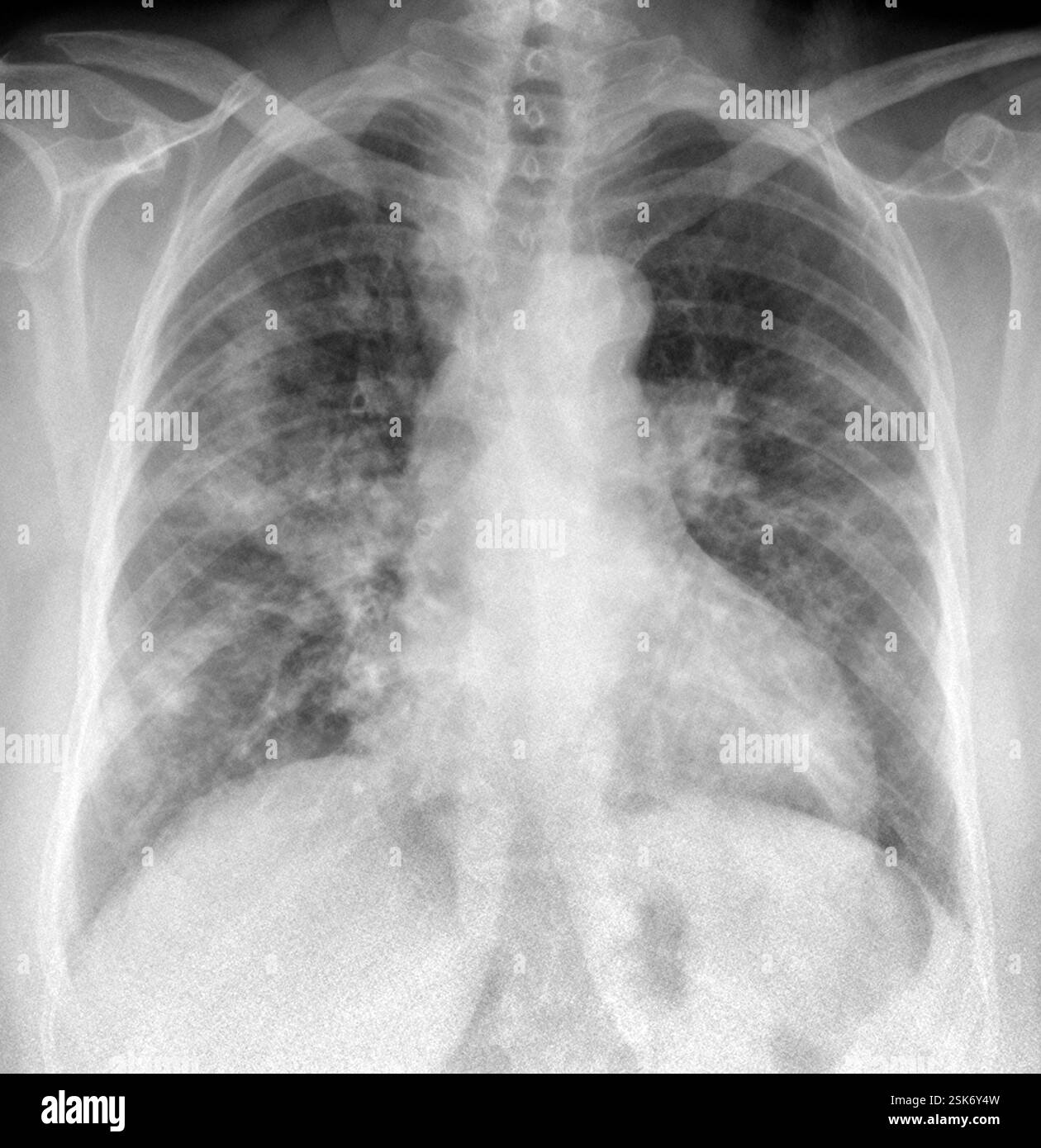 Bacterial lobular pneumonia. Chest X-ray showing the lungs of a 58-year ...
