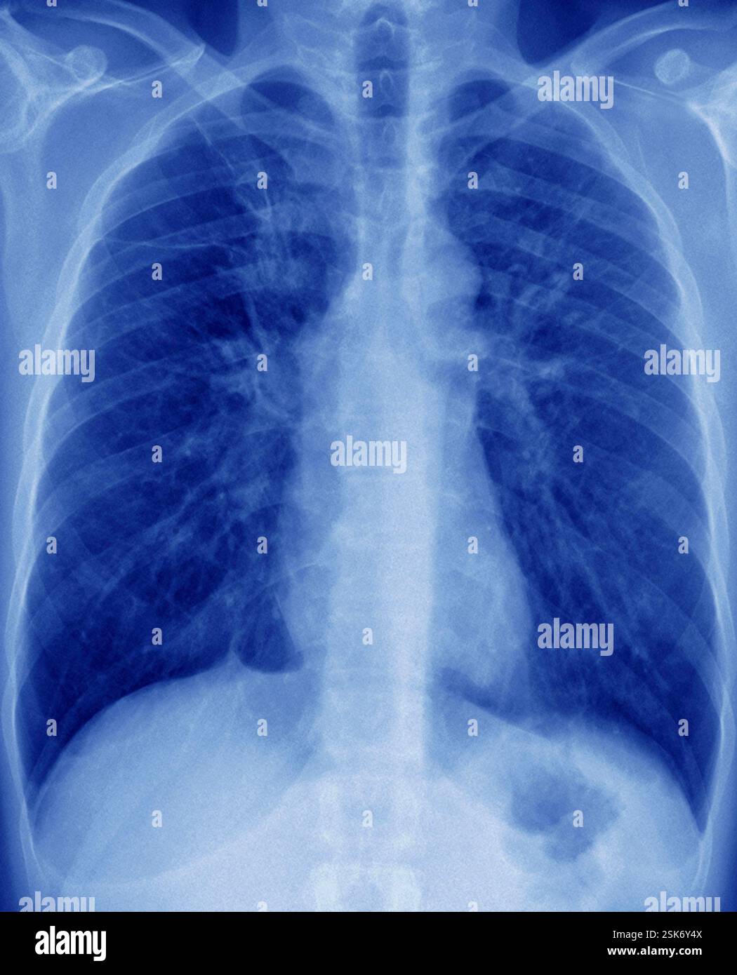 Pulmonary fibrosis in sarcoidosis. Coloured frontal X-ray of the chest ...