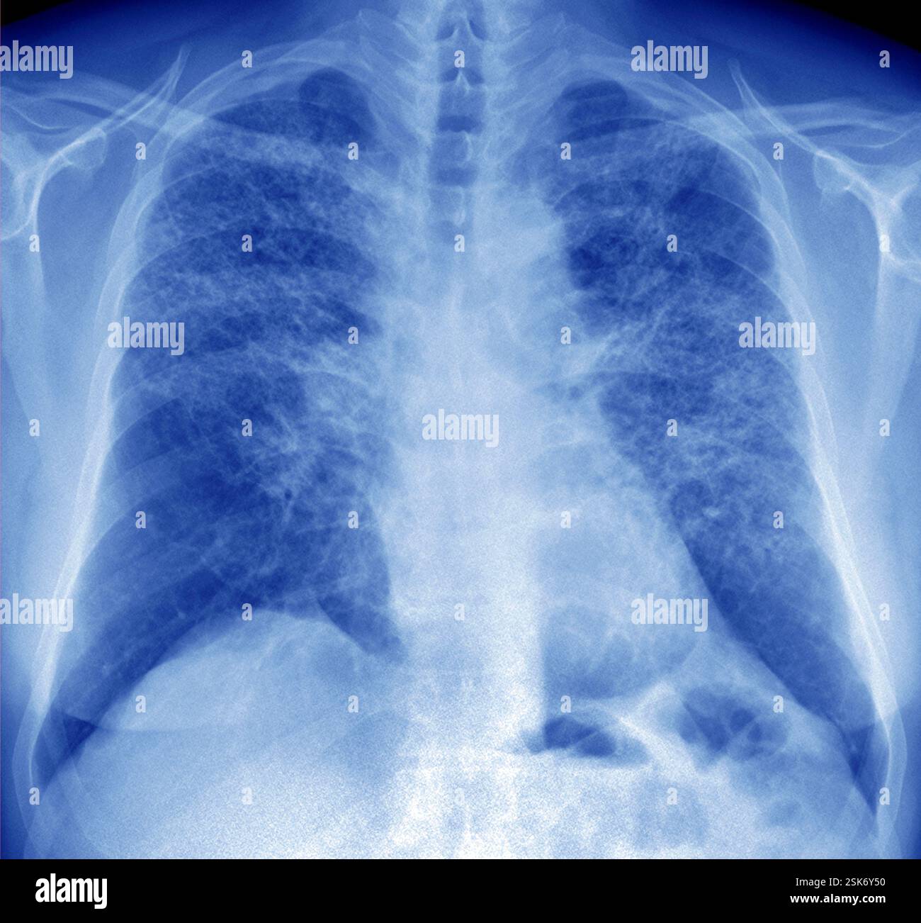 Pulmonary fibrosis. Coloured X-ray of the chest of a 57-year-old male ...