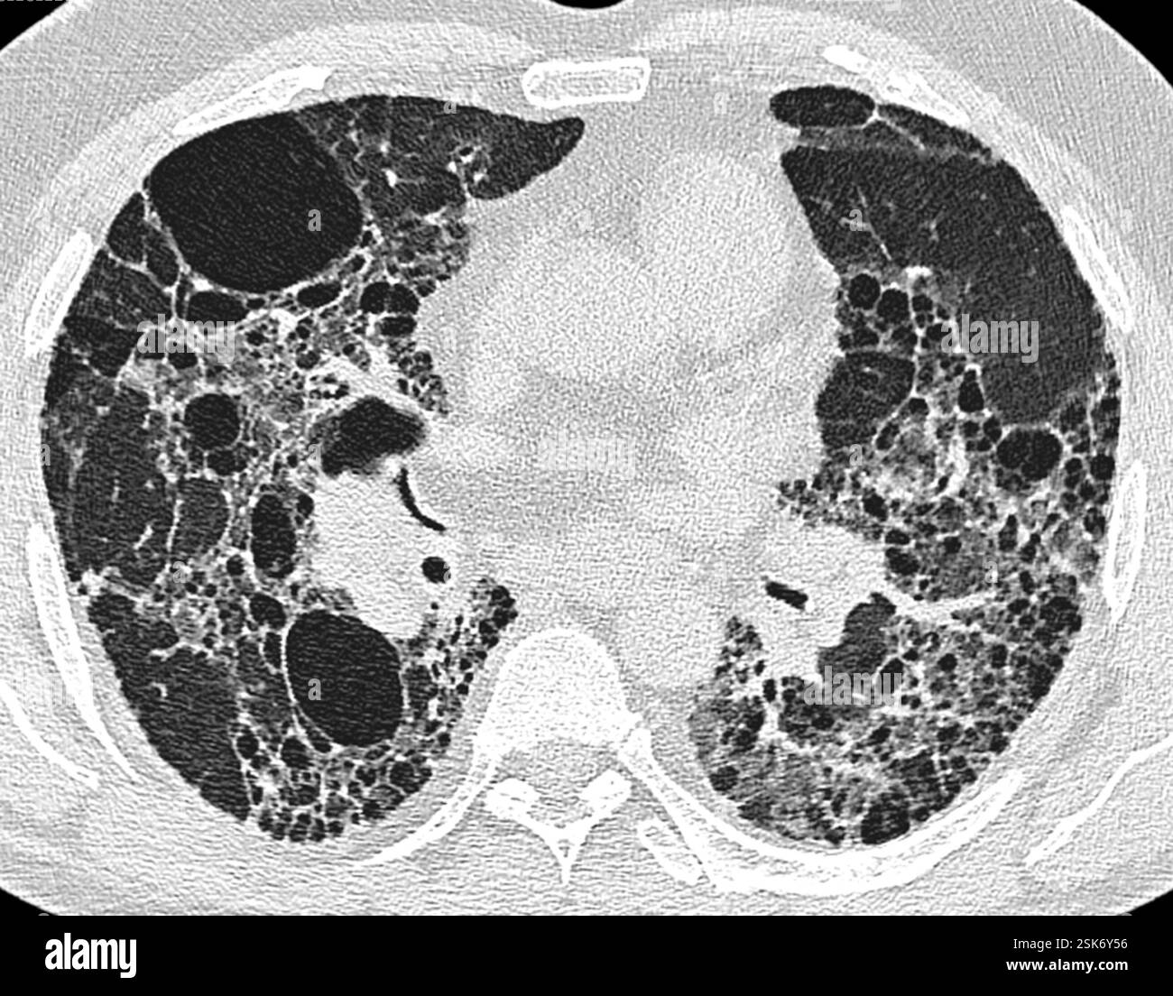 Lungs in hypersensitivity pneumonitis. Axial computed tomography (CT ...