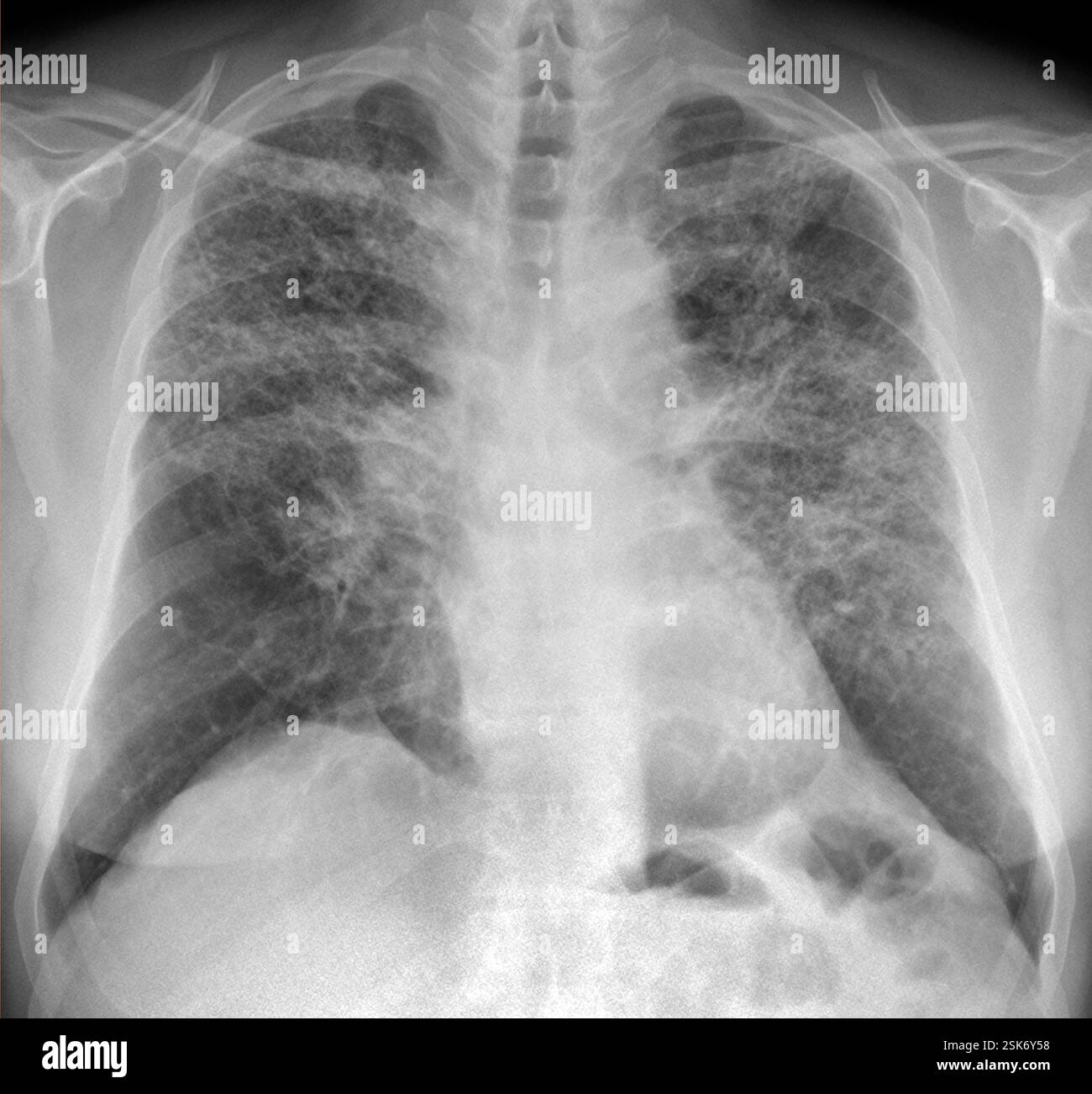 Pulmonary fibrosis. X-ray of the chest of a 57-year-old male patient ...