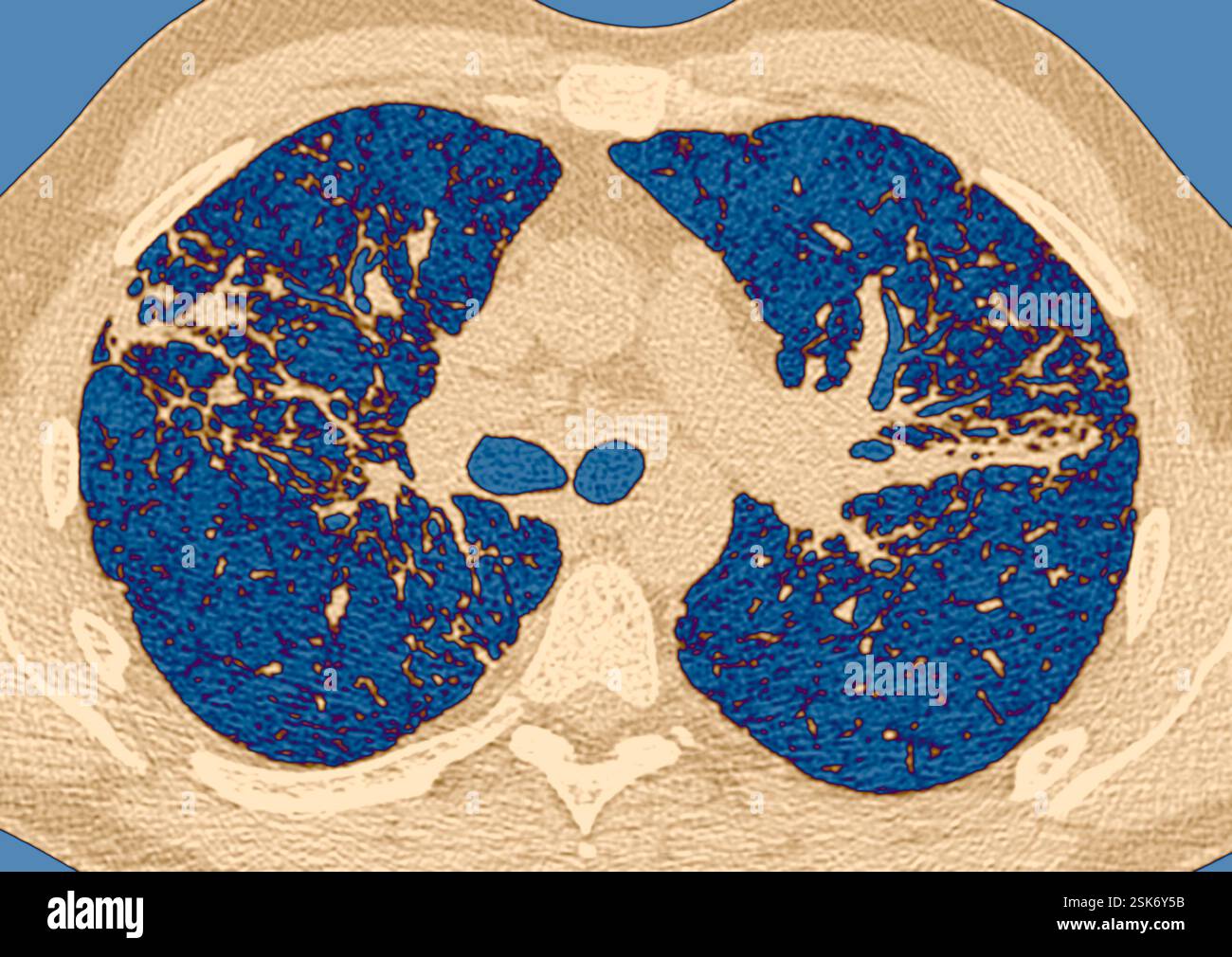 Pulmonary fibrosis in sarcoidosis. Coloured axial computed tomography ...