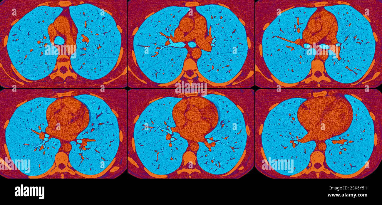 Lungs and heart. Sequence of six coloured axial CT (computed tomography ...