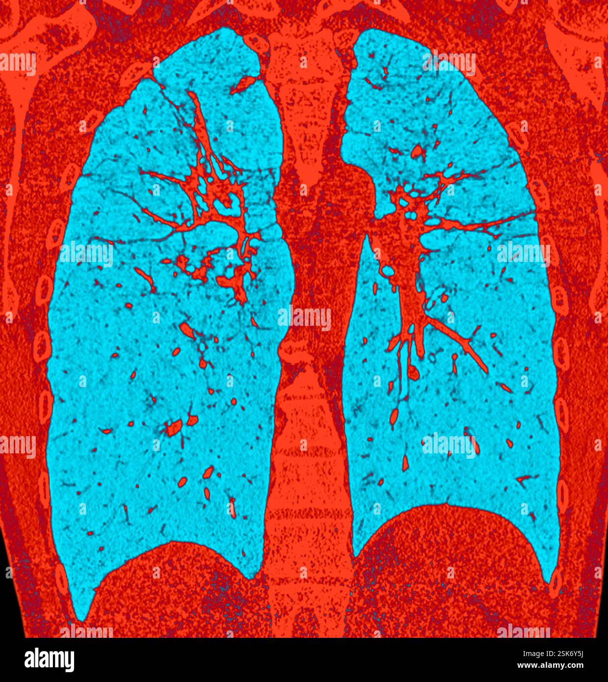 Pulmonary fibrosis in sarcoidosis. Coloured coronal computed tomography ...