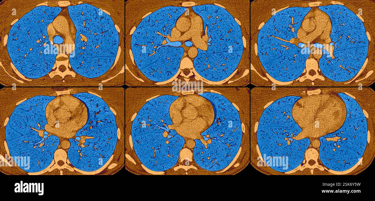 Lungs and heart. Sequence of six coloured axial CT (computed tomography ...