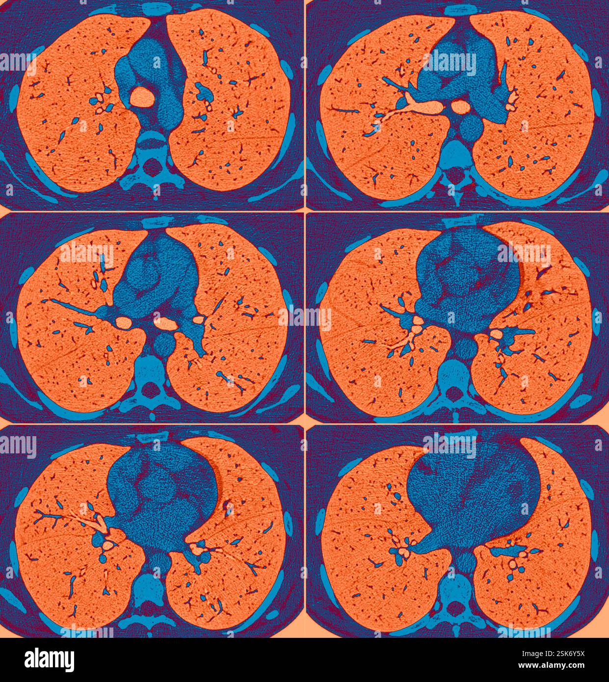 Lungs and heart. Sequence of six coloured axial CT (computed tomography ...