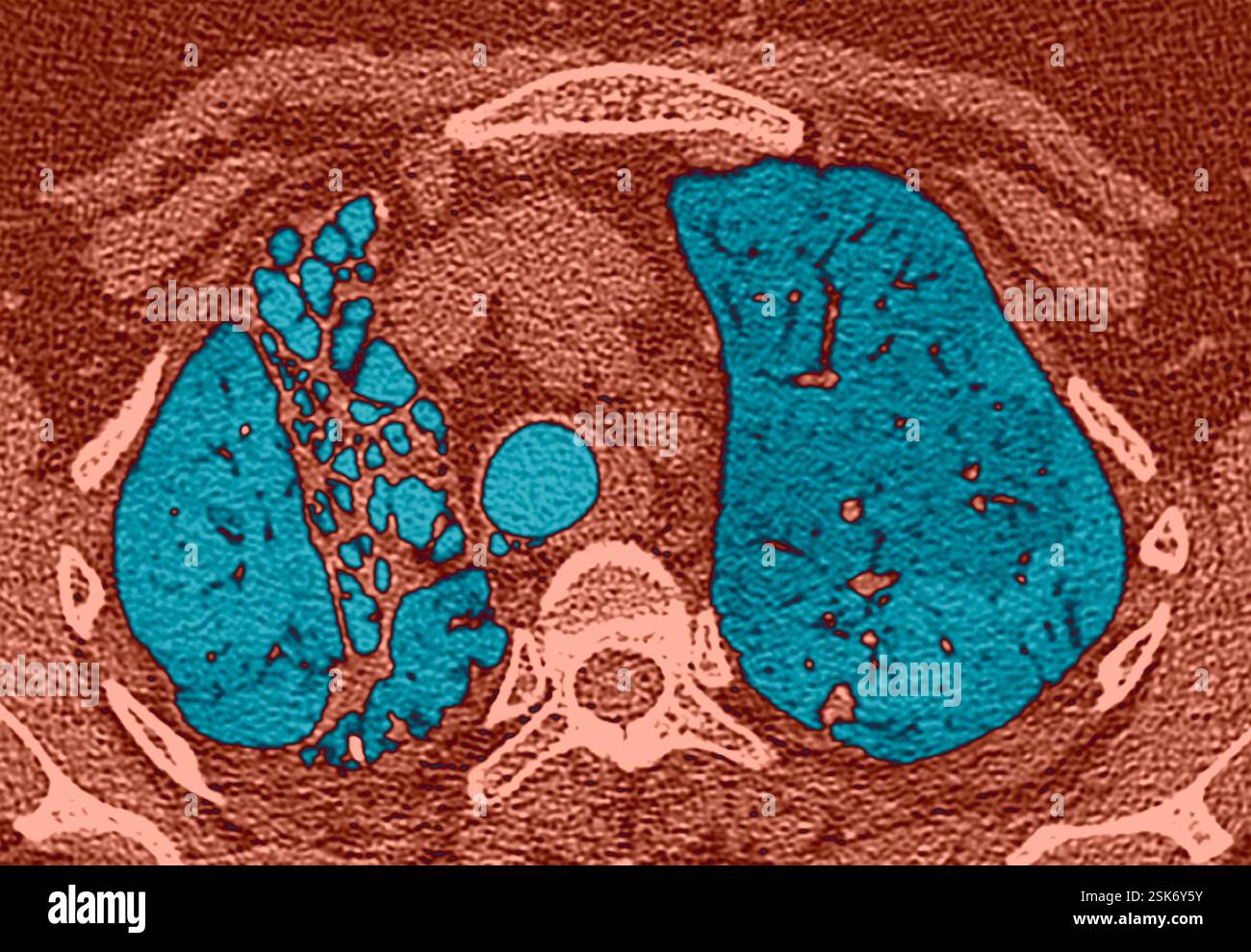 Lung damage from pulmonary tuberculosis. Coloured computed tomography (CT) scan of an axial ...