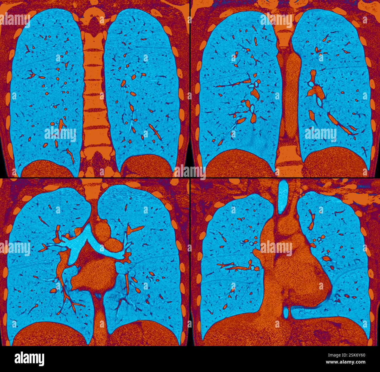 Lungs and heart. Sequence of four coloured coronal CT (computed ...