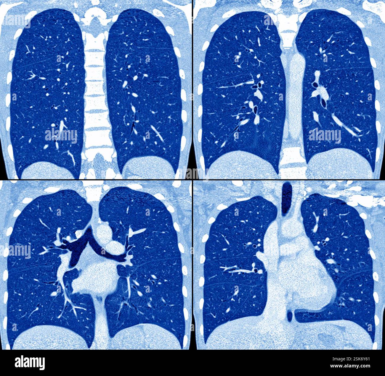 Lungs and heart. Sequence of four coloured coronal CT (computed ...