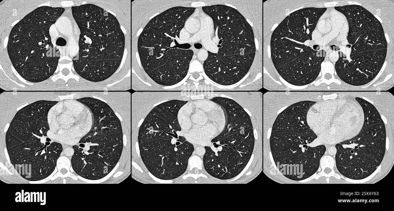 Lungs and heart. Sequence of six axial CT (computed tomography) scans ...