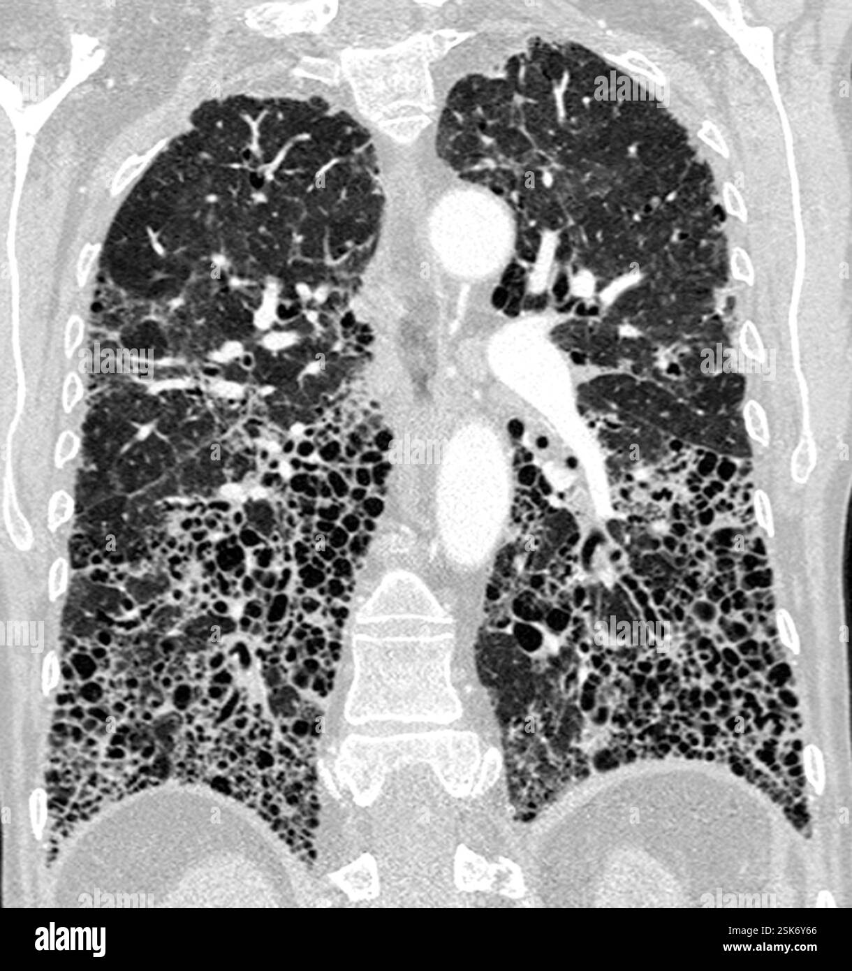 Usual interstitial pneumonia (UIP) in rheumatoid arthritis. Coronal ...