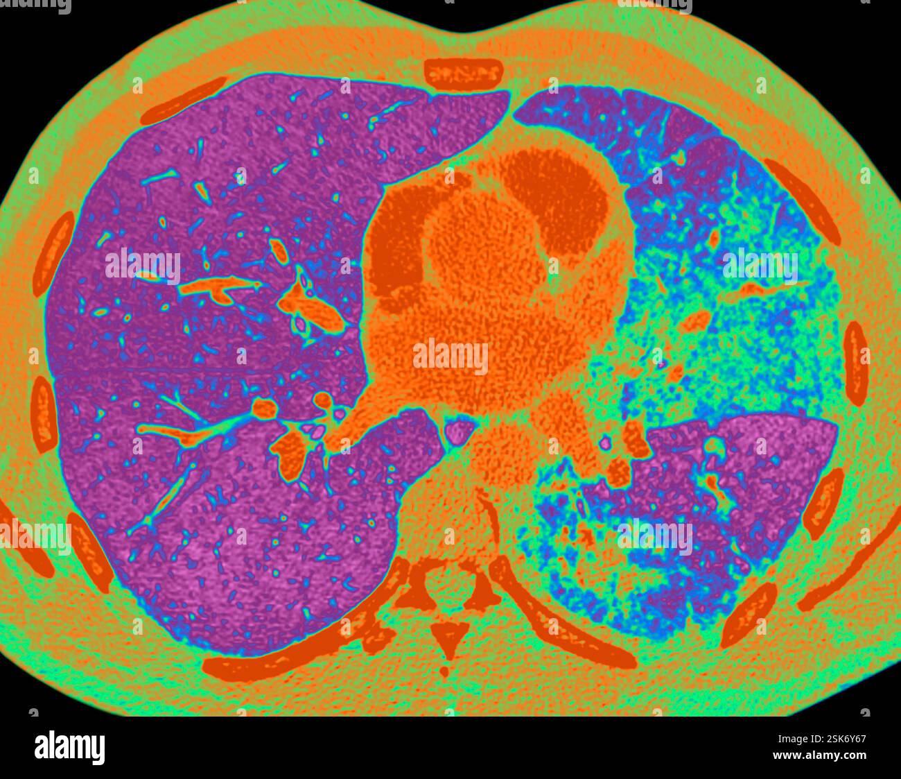Pneumococcal pneumonia. Coloured axial computed tomography (CT) scan of ...