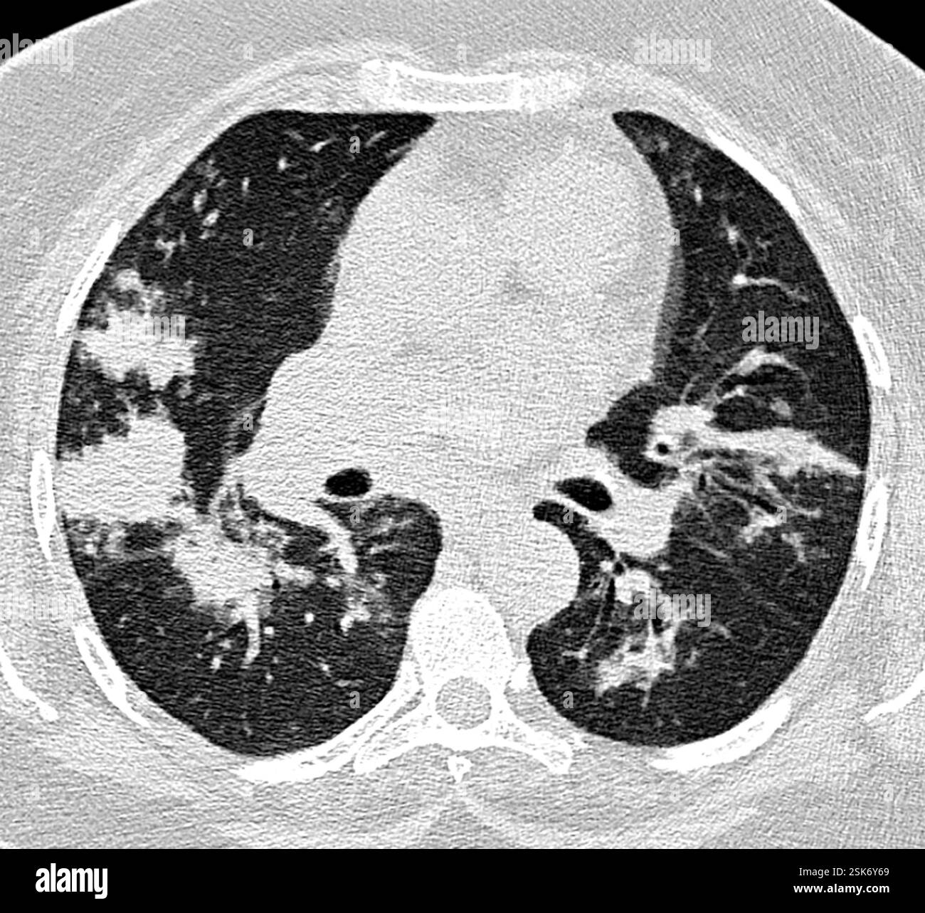 Bacterial lobular pneumonia. Computed tomography (CT) scan showing a ...