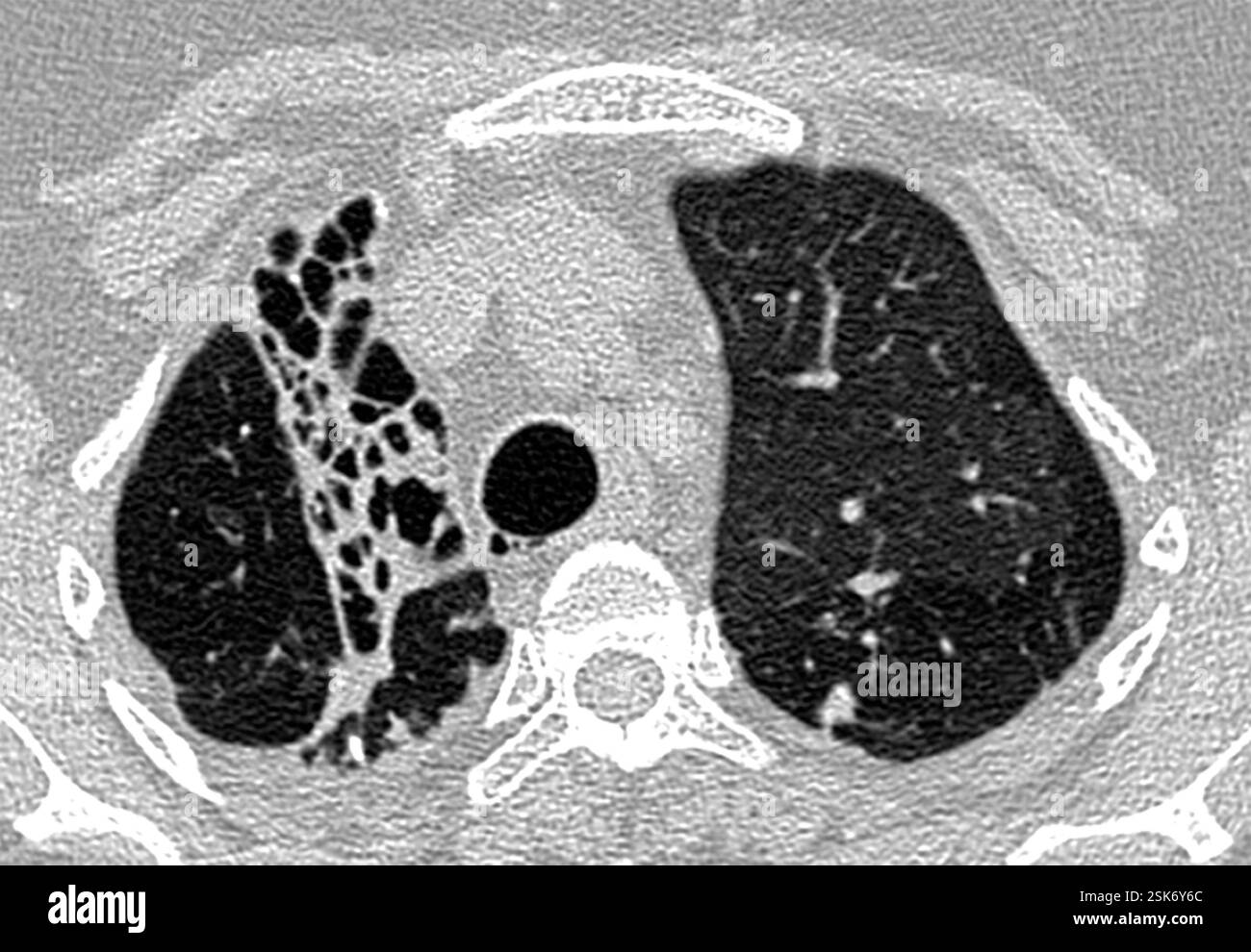 Lung damage from pulmonary tuberculosis. Computed tomography (CT) scan of an axial section ...