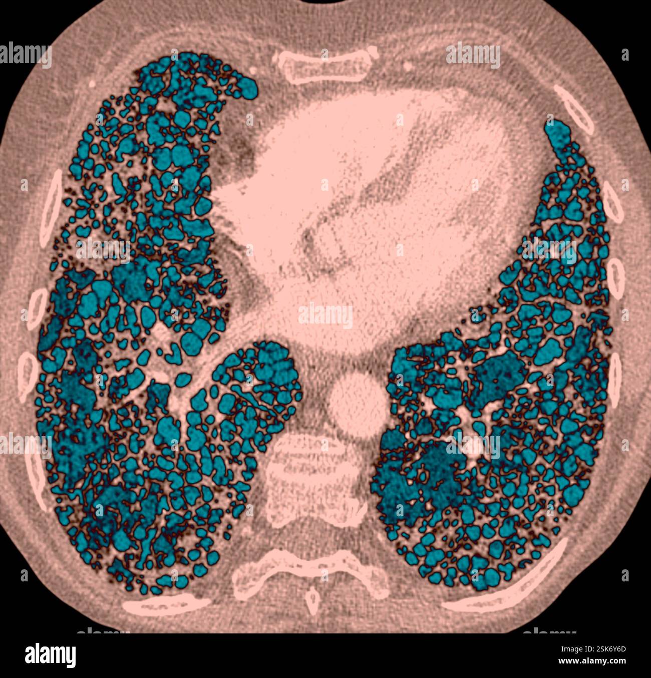 Kaposi's sarcoma cancer Stock Photo - Alamy
