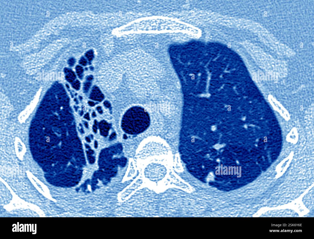 Lung damage from pulmonary tuberculosis. Coloured computed tomography ...