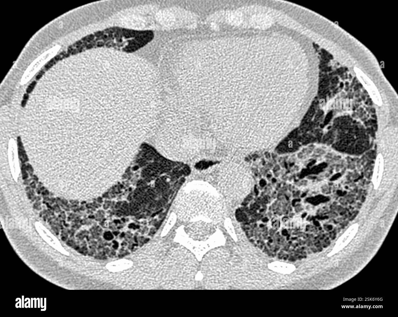 Non-specific interstitial pneumonia (NSIP) in rheumatoid arthritis ...