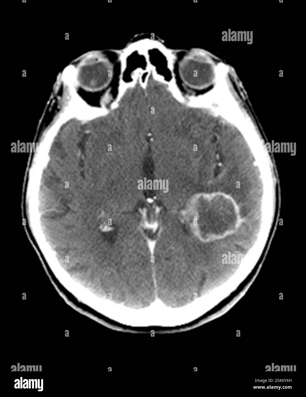 Heart attack, SPECT scans Stock Photo - Alamy