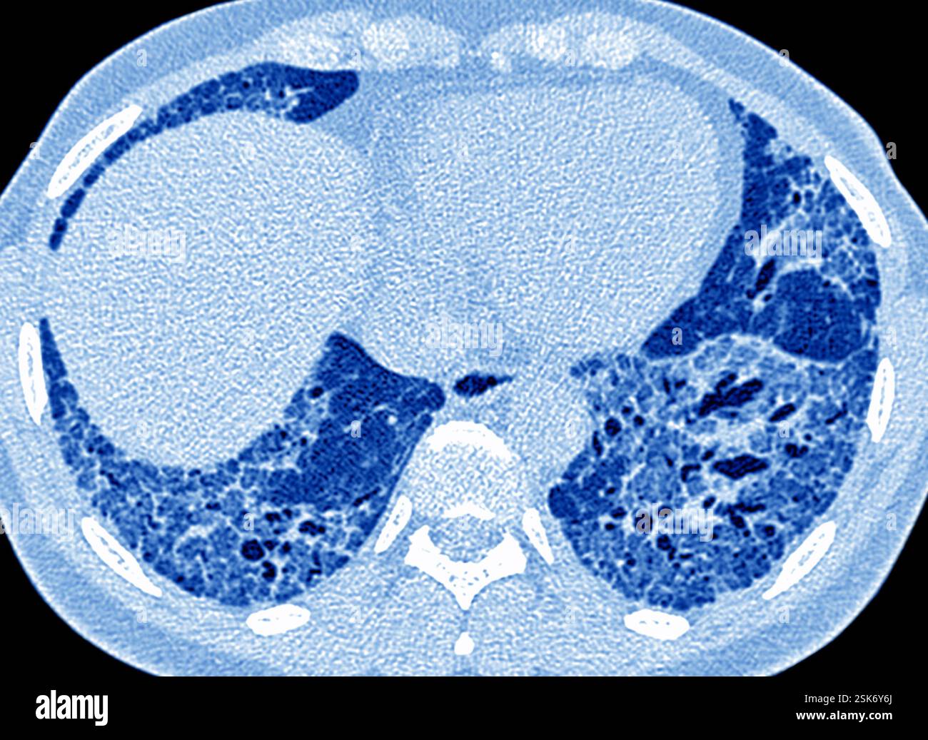 Skin sweat gland and duct, light micrograph Stock Photo - Alamy