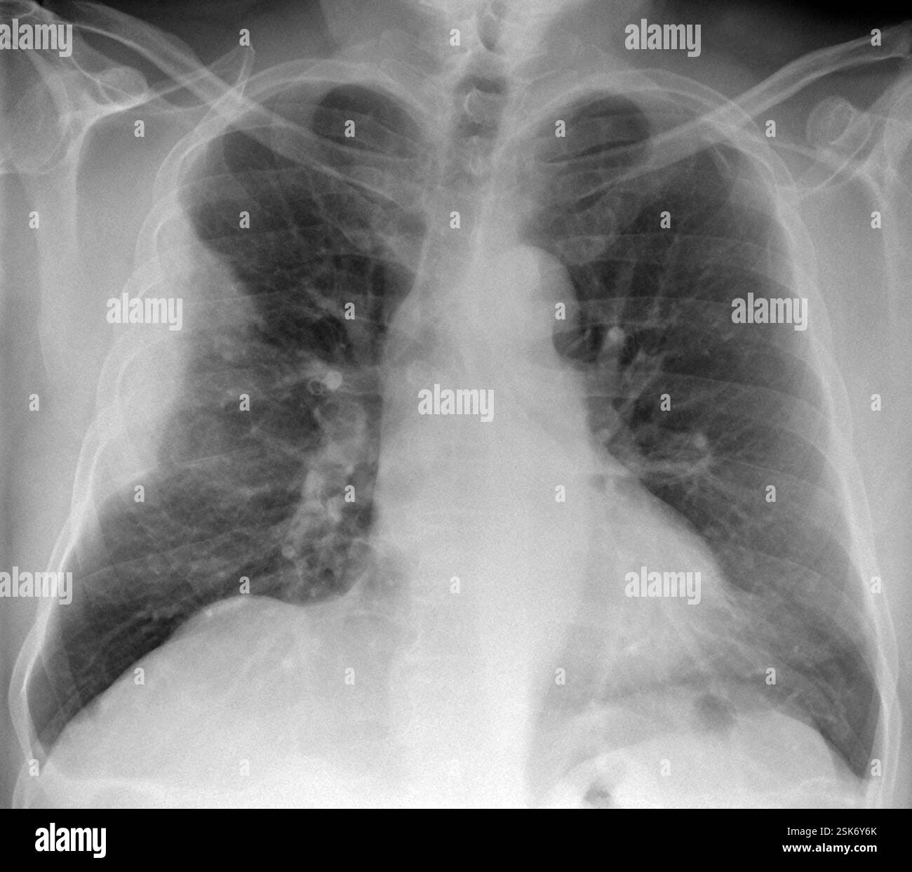 Bacterial pneumonia. Frontal X-ray of the lungs of a 53-year-old man ...