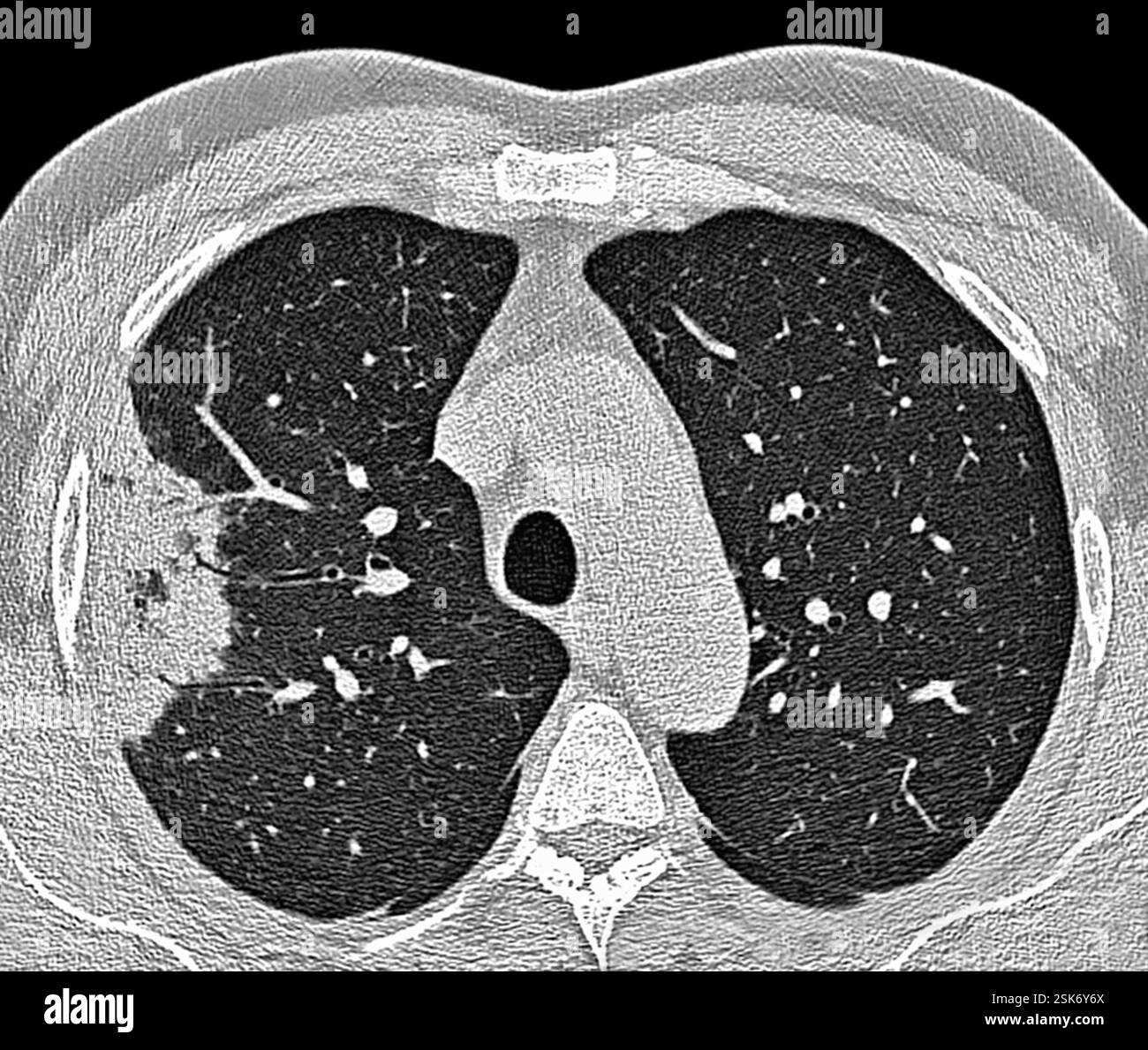 Bacterial pneumonia. Axial computed tomography (CT) scan through the ...