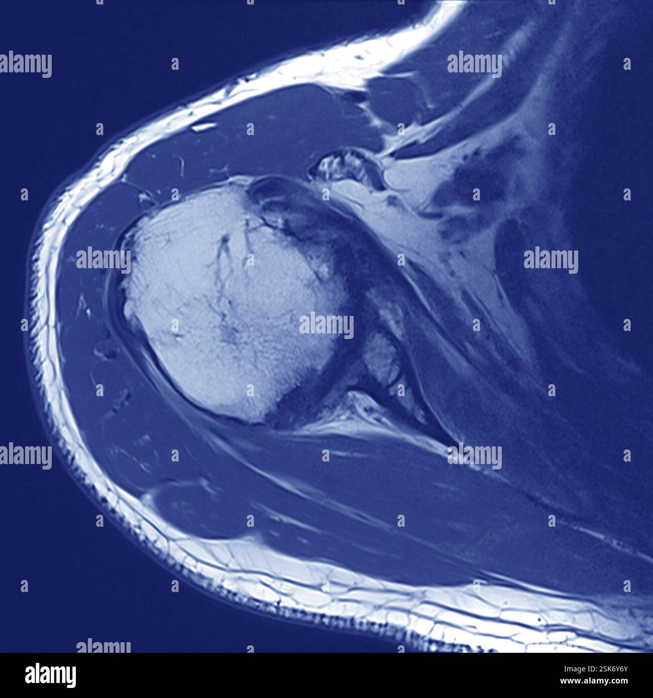 Osteoarthritis of the shoulder. Coloured axial magnetic resonance ...