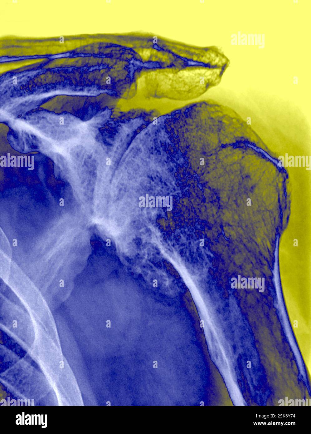 Osteoarthritis of the shoulder. Coloured frontal X-ray of the left ...