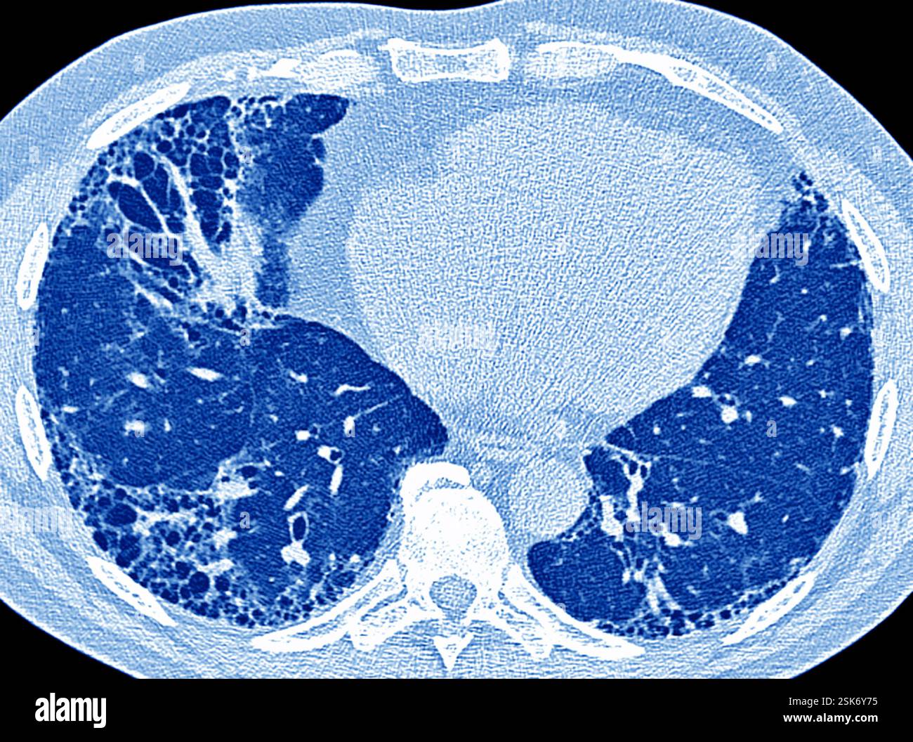 Smoking-related interstitial pneumonia, frontal chest X-ray Stock Photo ...