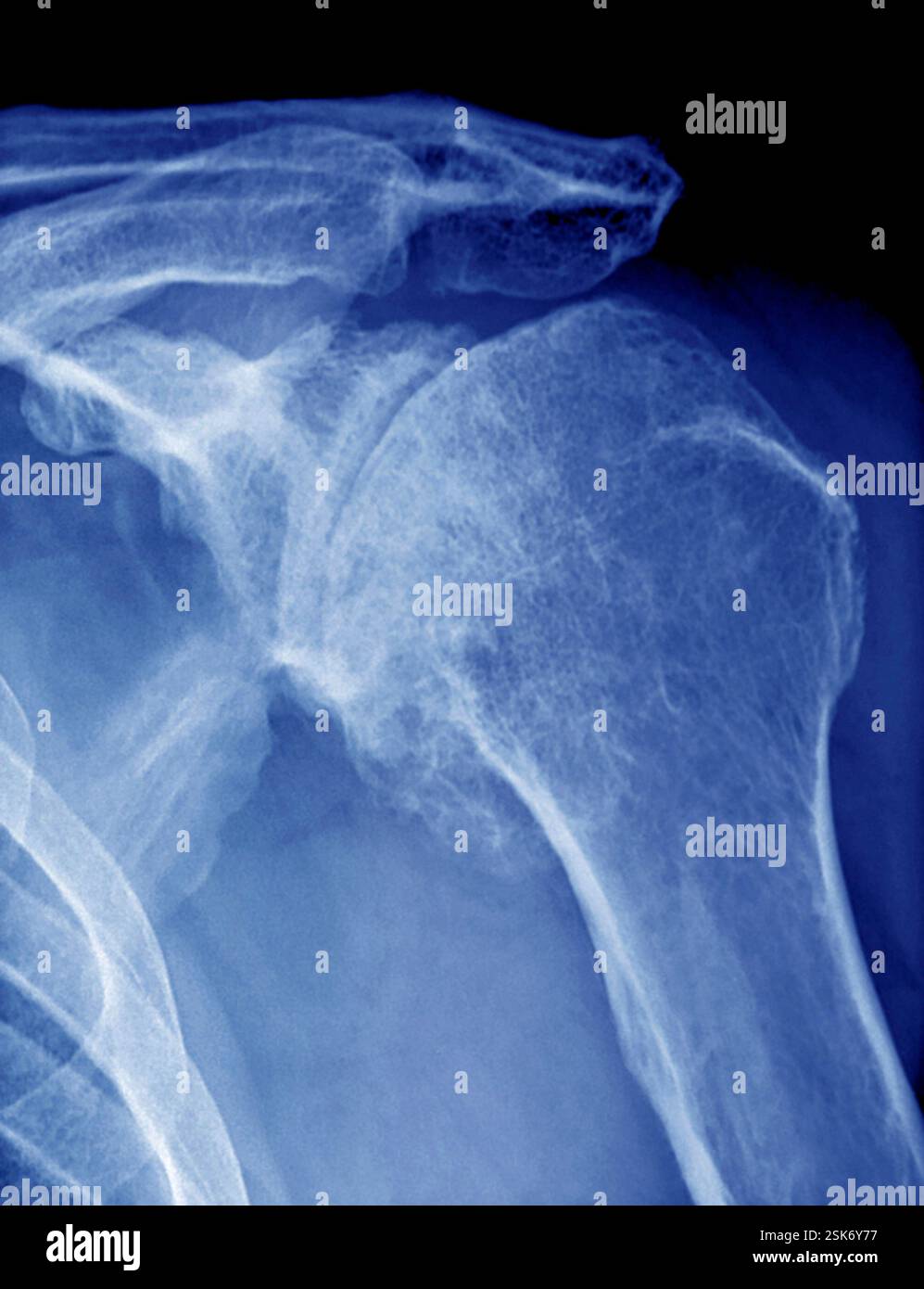Osteoarthritis of the shoulder. Frontal X-ray of the left shoulder of a ...