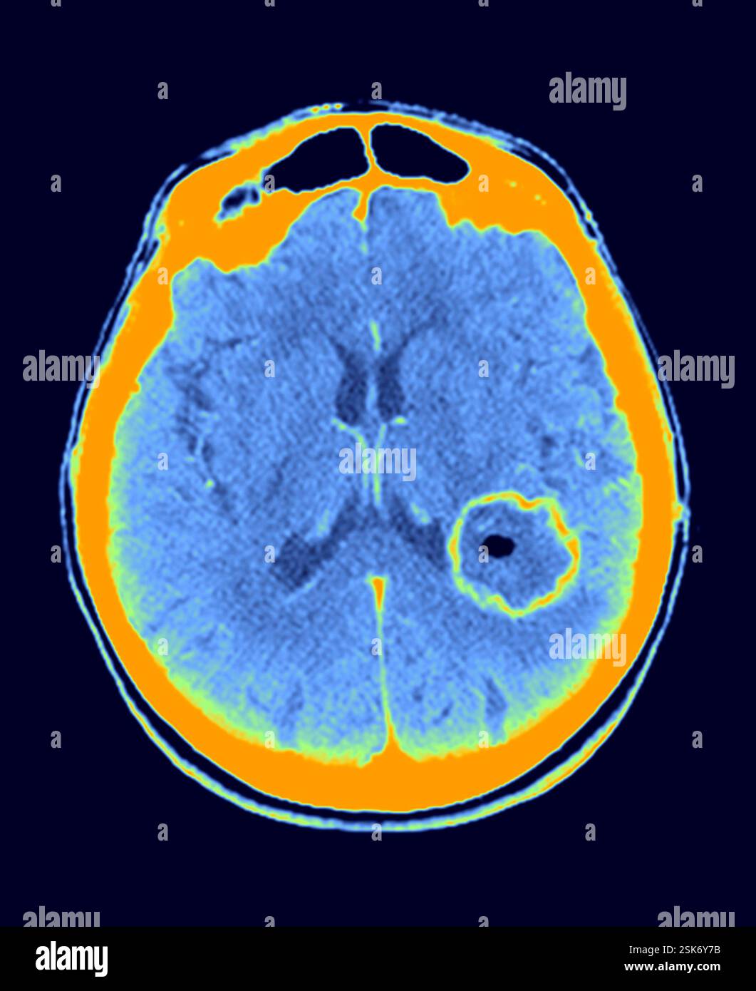 Glioblastoma. Coloured axial computed tomography (CT) scan through the brain of a 52-year-old ...