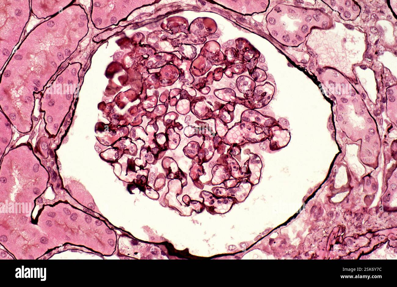 Cryoglobulinemia. Light micrograph of a section through a glomerulus ...