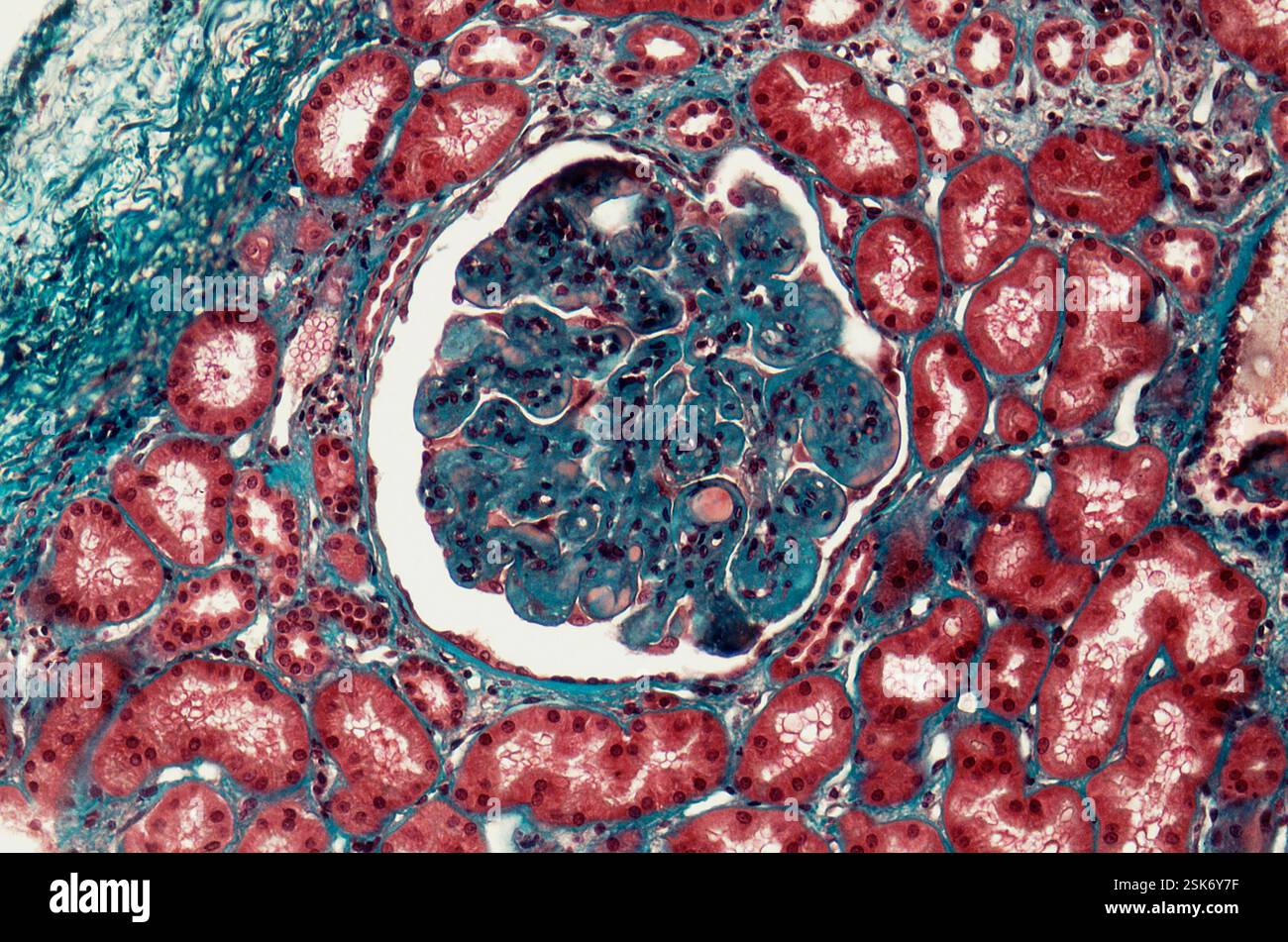 Cryoglobulinemia. Light micrograph of a section through a glomerulus ...