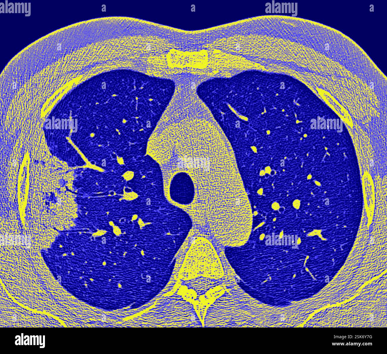 Bacterial pneumonia. Coloured axial computed tomography (CT) scan ...
