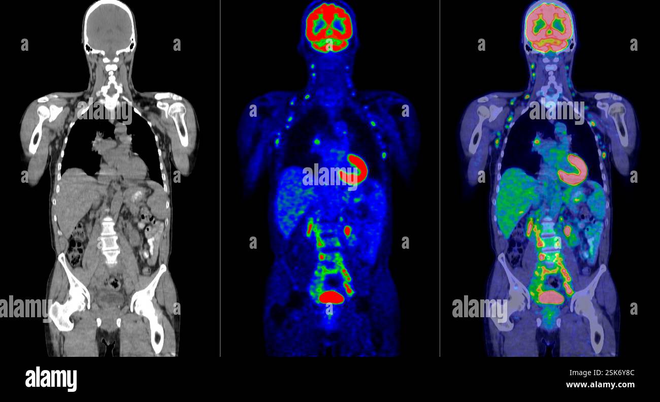 Follicular lymphoma. Coronal CT scan (left), coloured positron emission ...