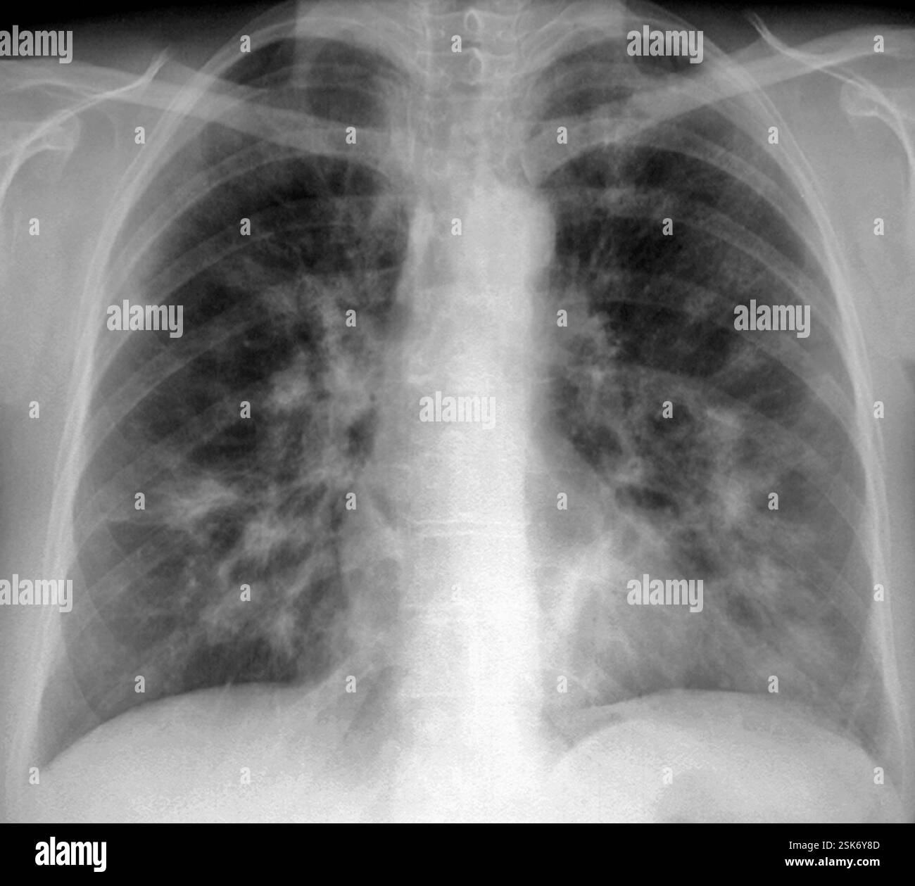 Diffuse interstitial pneumonia (infiltrating lung disease). Chest X-ray ...