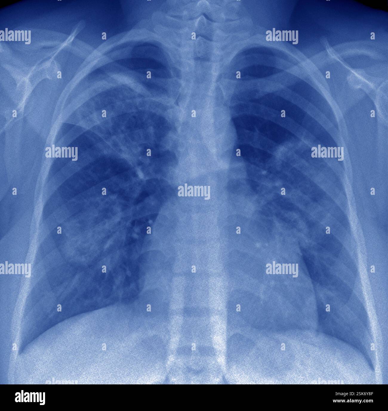 Interstitial pneumonia (infiltrating lung disease). Coloured chest X ...