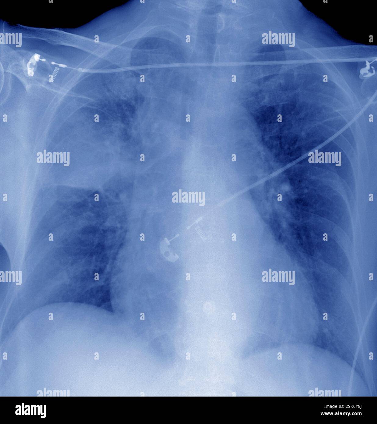 Lobar pneumonia. Coloured frontal X-ray of the lungs of a 48-year-old ...