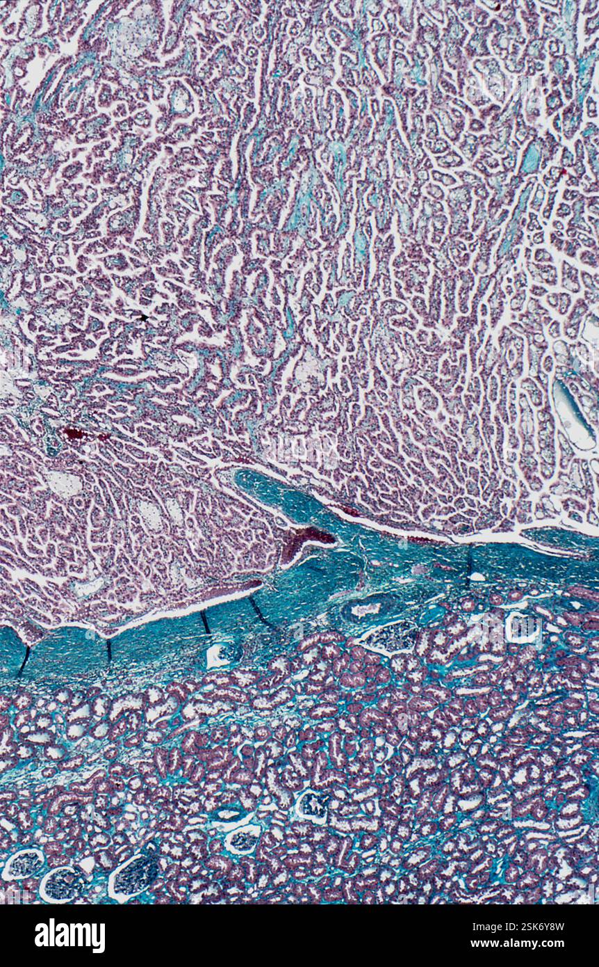 Kidney cancer. Light micrograph of a section through tissue from a ...