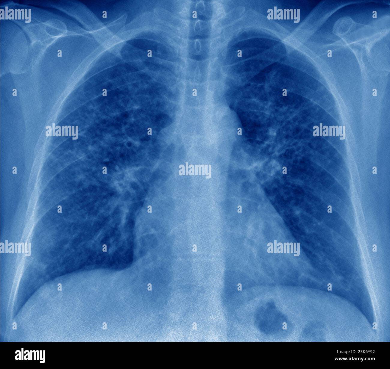 Interstitial pneumonia (infiltrating lung disease) in sarcoidosis ...