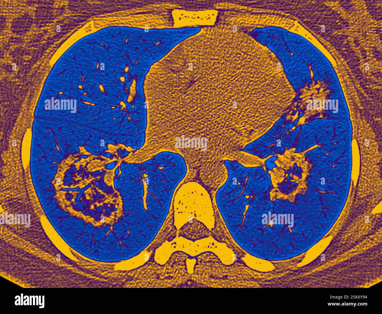 Interstitial pneumonia (infiltrating lung disease). Coloured axial ...