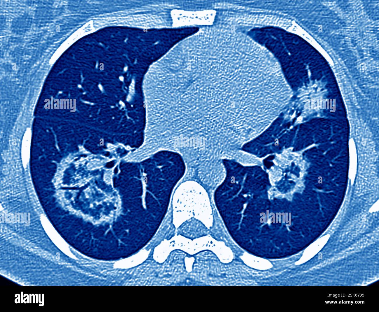 Interstitial pneumonia (infiltrating lung disease). Coloured axial ...
