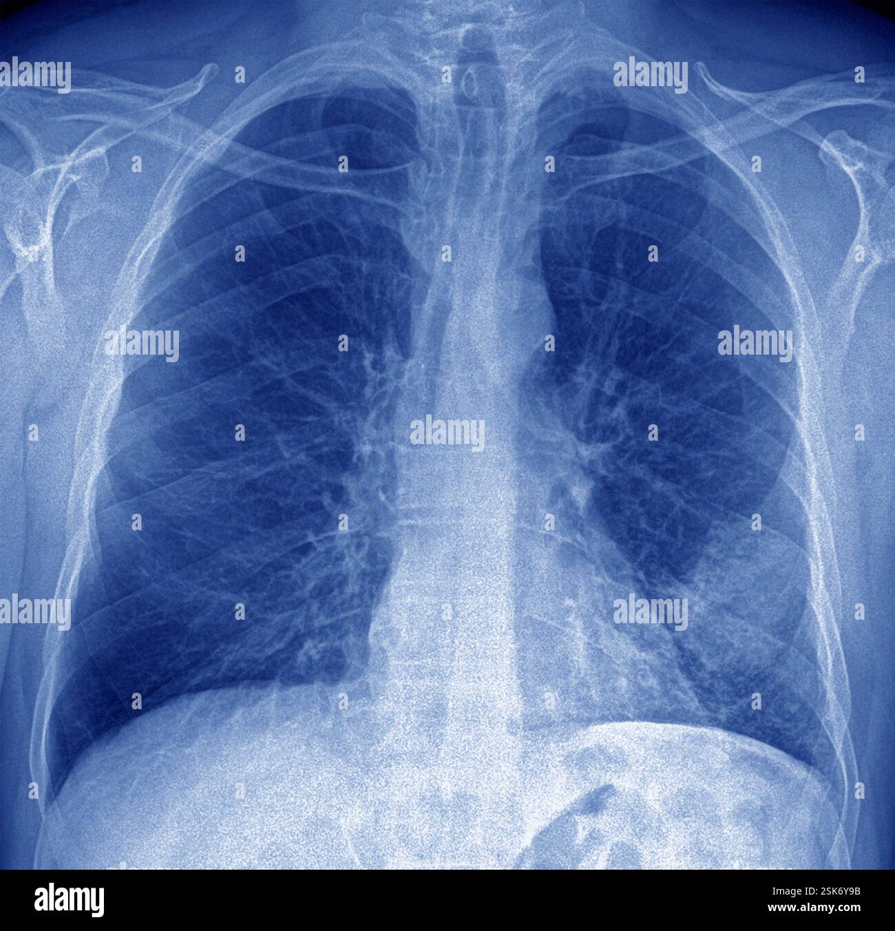 Pneumonia. Coloured frontal X-ray of the lungs of a 51-year-old man ...