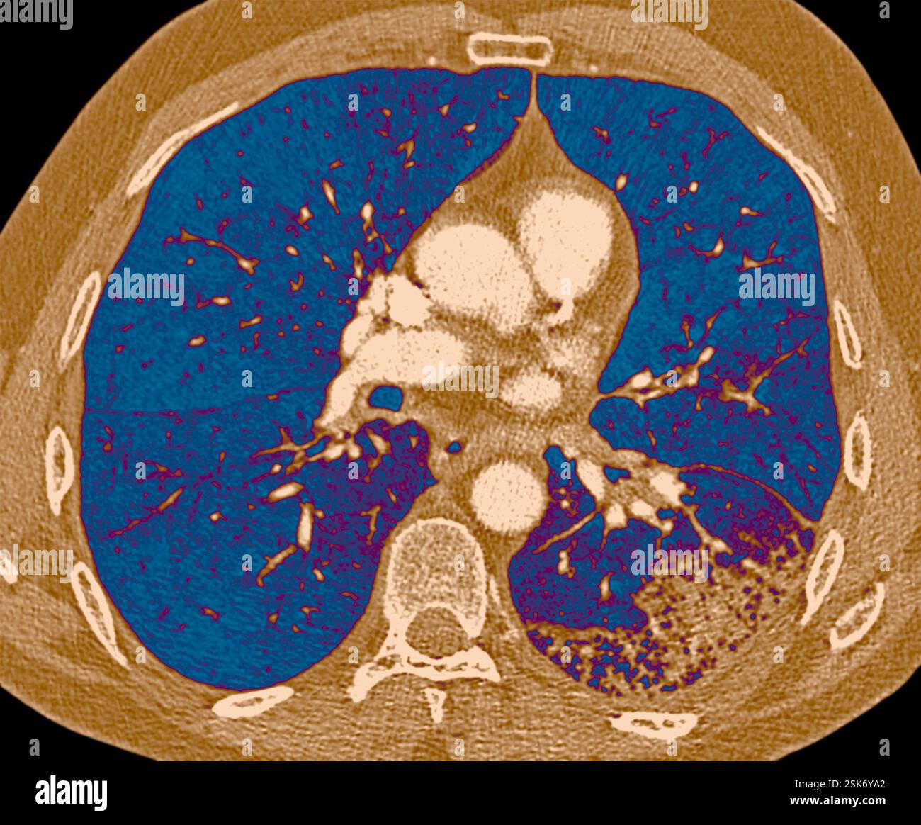 Pneumonia. Coloured axial computed tomography (CT) scan through the ...
