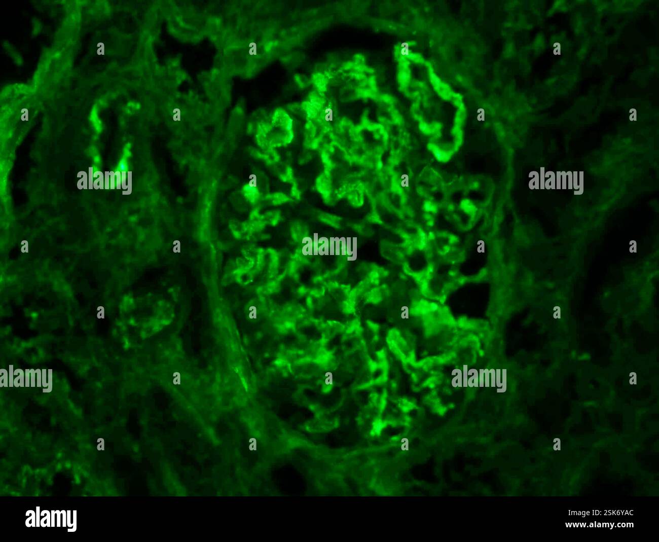Lupus nephritis. Immunofluorescence Iight micrograph of a glomerulus, a ...